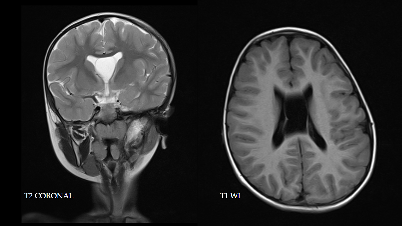 Ultimate Radiology : Arachnoid cyst of Septum Pellucidum