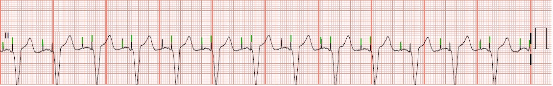 EKG Rhythm Strips 56: Atrial Fibrillation