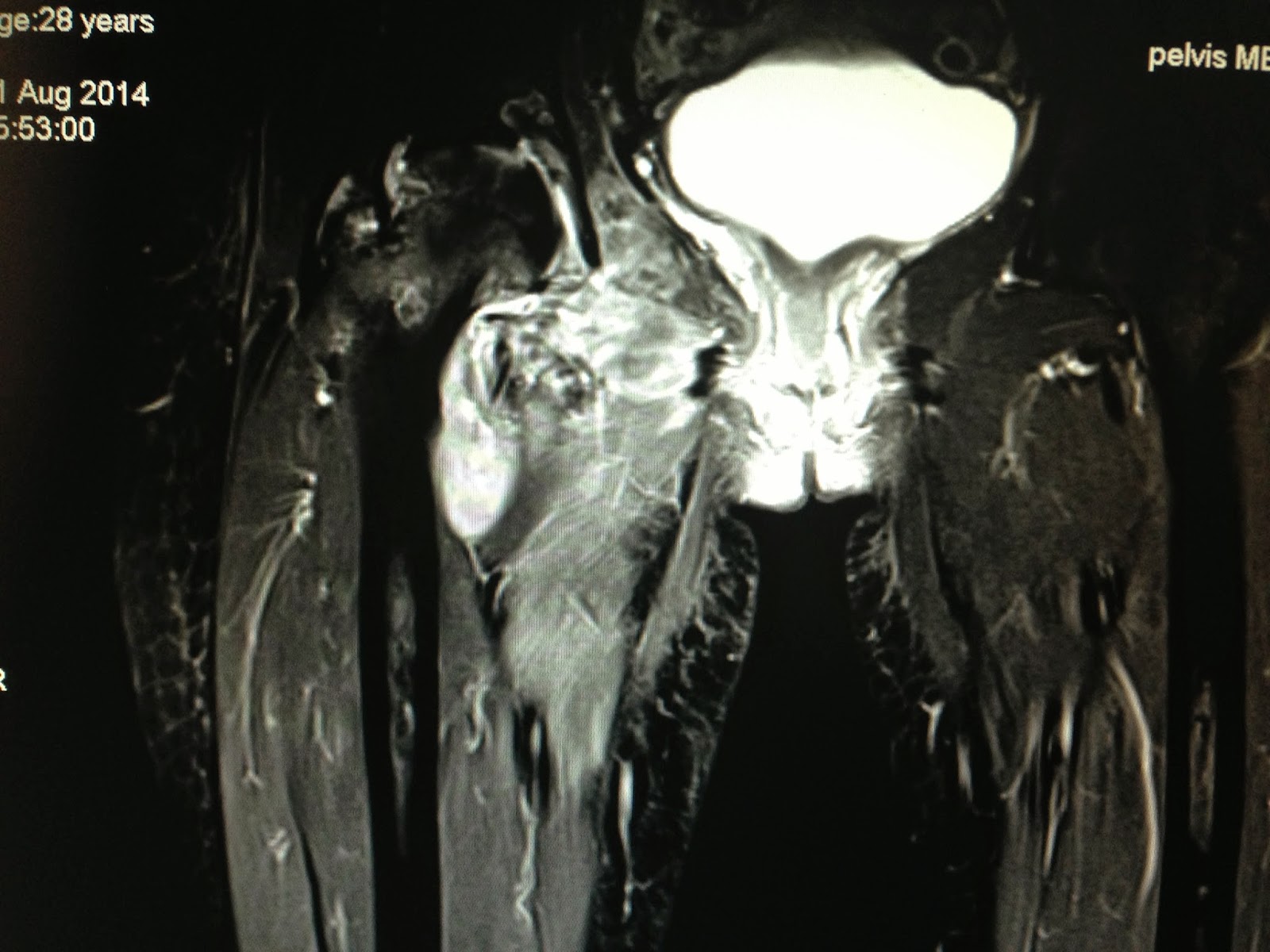 VIETNAMESE MEDIC ULTRASOUND: CASE 283: SCARPA TRIANGLE MASS, Dr PHAN ...