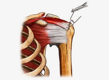 A punta de bisturí: Reparación del tendón o tenoplastia