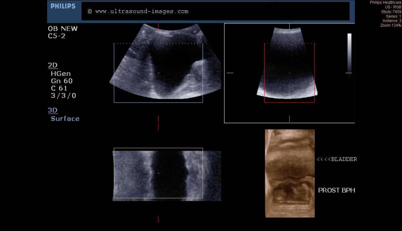 Benign hypertrophy of prostate- 3D ultrasound images ~ Ultrasound Cases ...