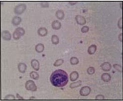 Células importantes en hematología: MICROCITOSIS