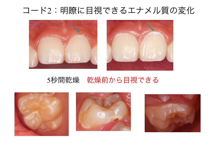 ICDAS-JHCDA: ICDAS Code2