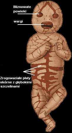 Płód Arlekin - problem społeczności hermetycznych?