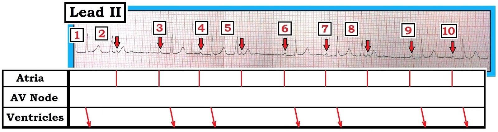ECG Interpretation: June 2013