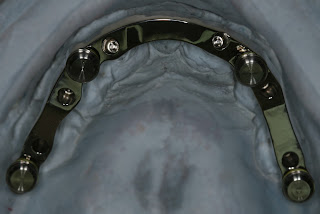 Dr. Workman, DDS: Implant Supported Dentures - Broomfield