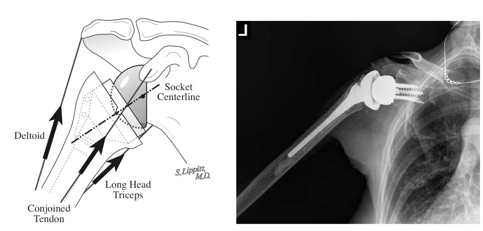 UW Shoulder and Elbow Academy: Reverse Total Shoulder for Combined ...