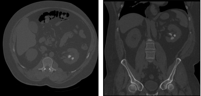 Madrid Urología: Litiasis Urinaria. Pruebas de Imagen.