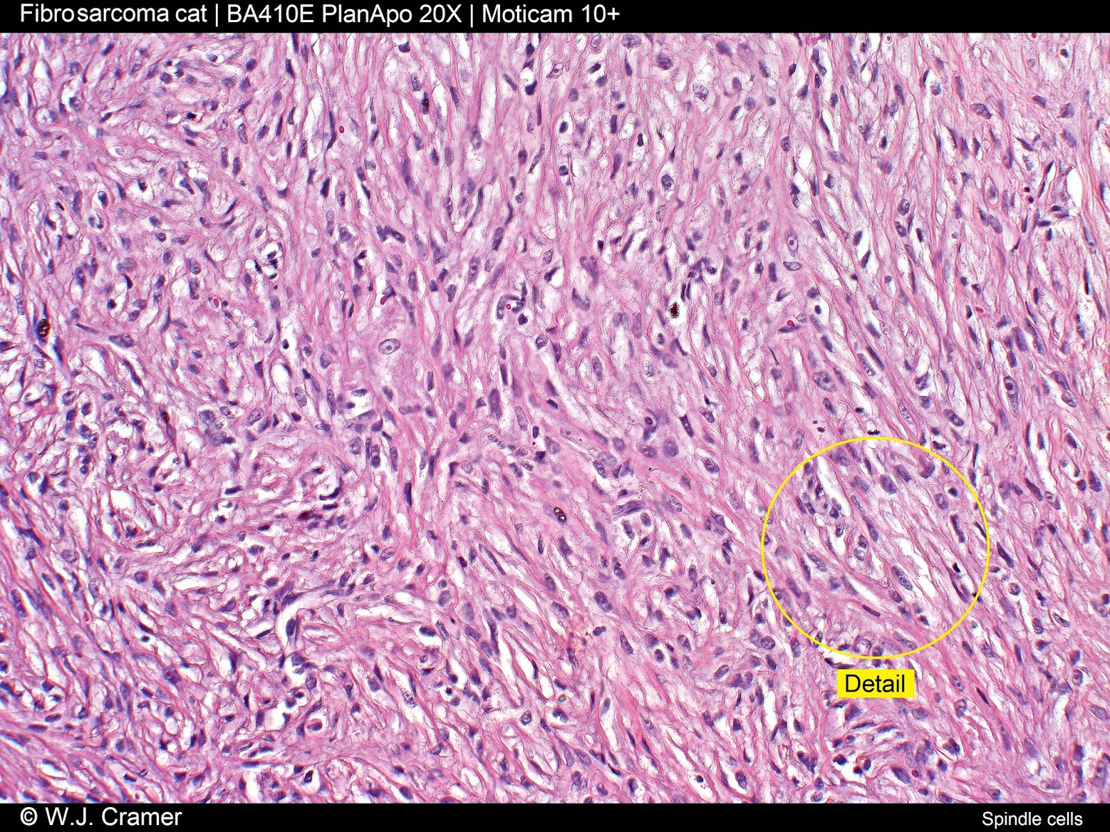 Fibrosarcoma