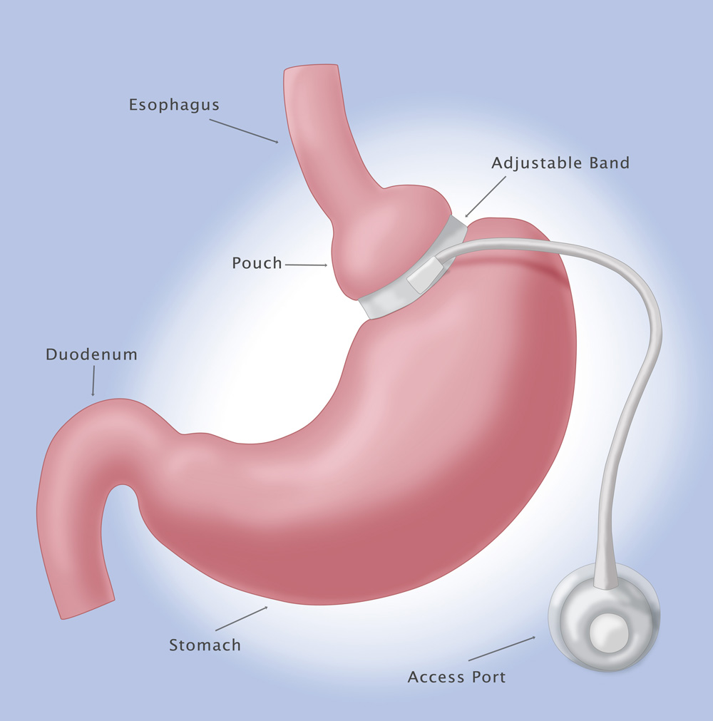 From the easy way out to no excuses...Living life with LapBand struggles