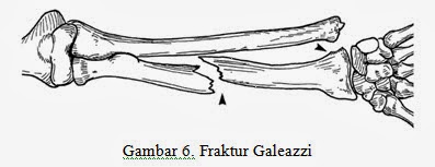 LAPORAN PENDAHULUAN FRAKTUR ANTEBRACHII
