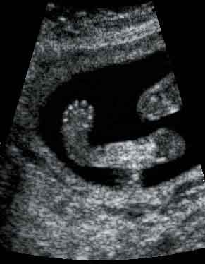 Mama Schell Says: Our Clubfoot Story - Part 1