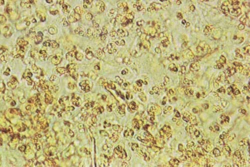 [Haematology] Microscopic Examination of Urinary Sediment - Cells ...