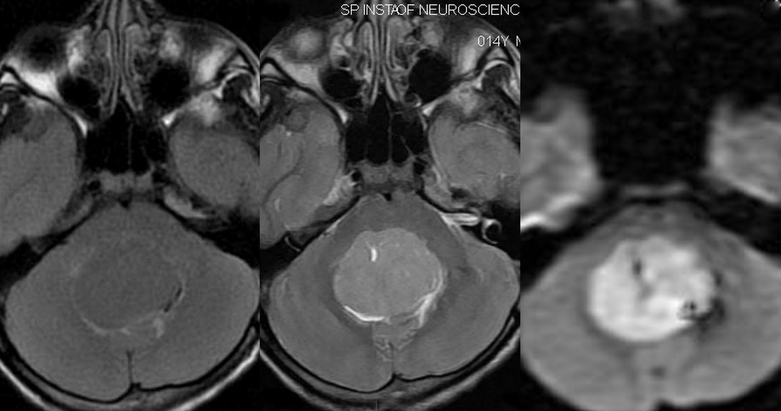 Dr Balaji Anvekar FRCR: Role of MRI Diffusion
