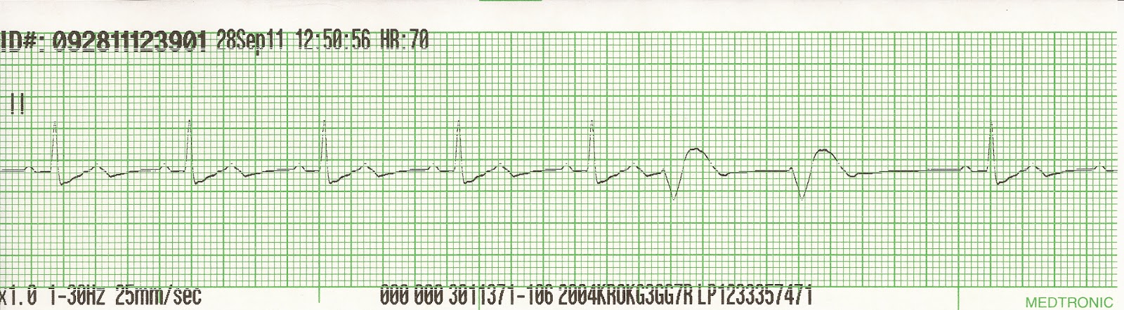 EKG Rhythm Strips 18: Ventricular Ectopy 1