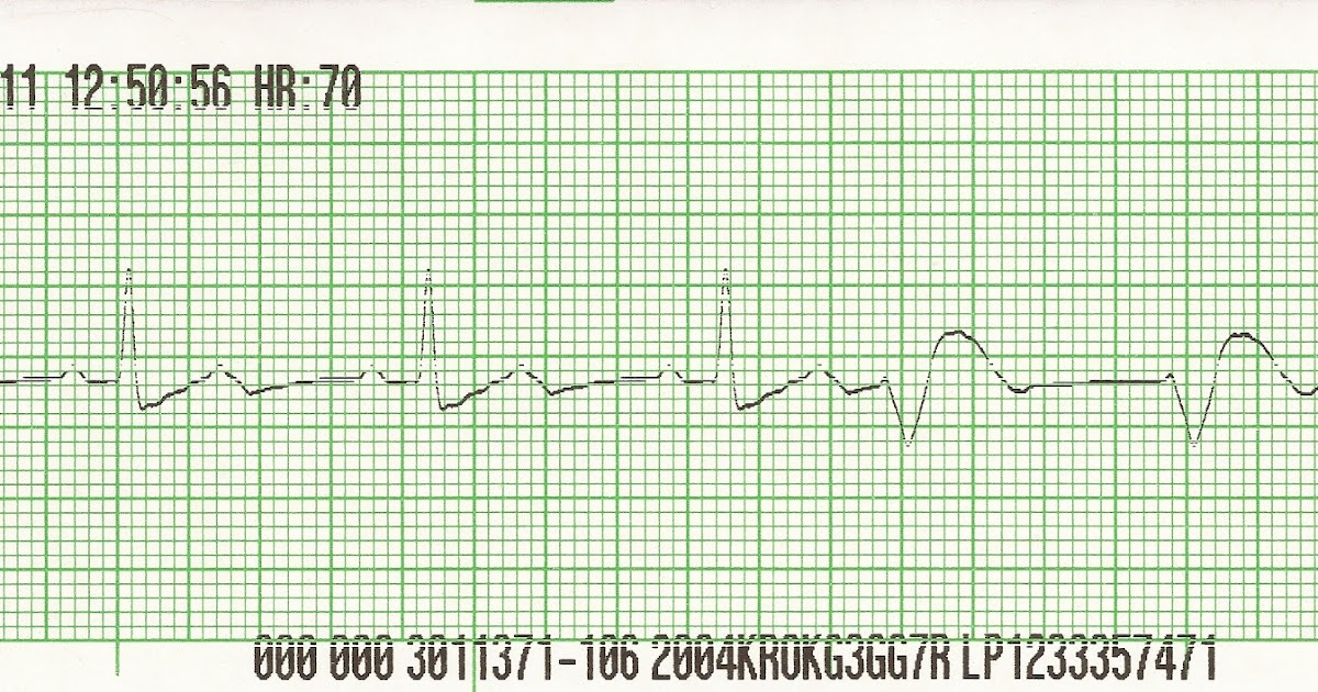 EKG Rhythm Strips 18: Ventricular Ectopy 1