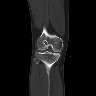 CT Knee - Radiology Imaging