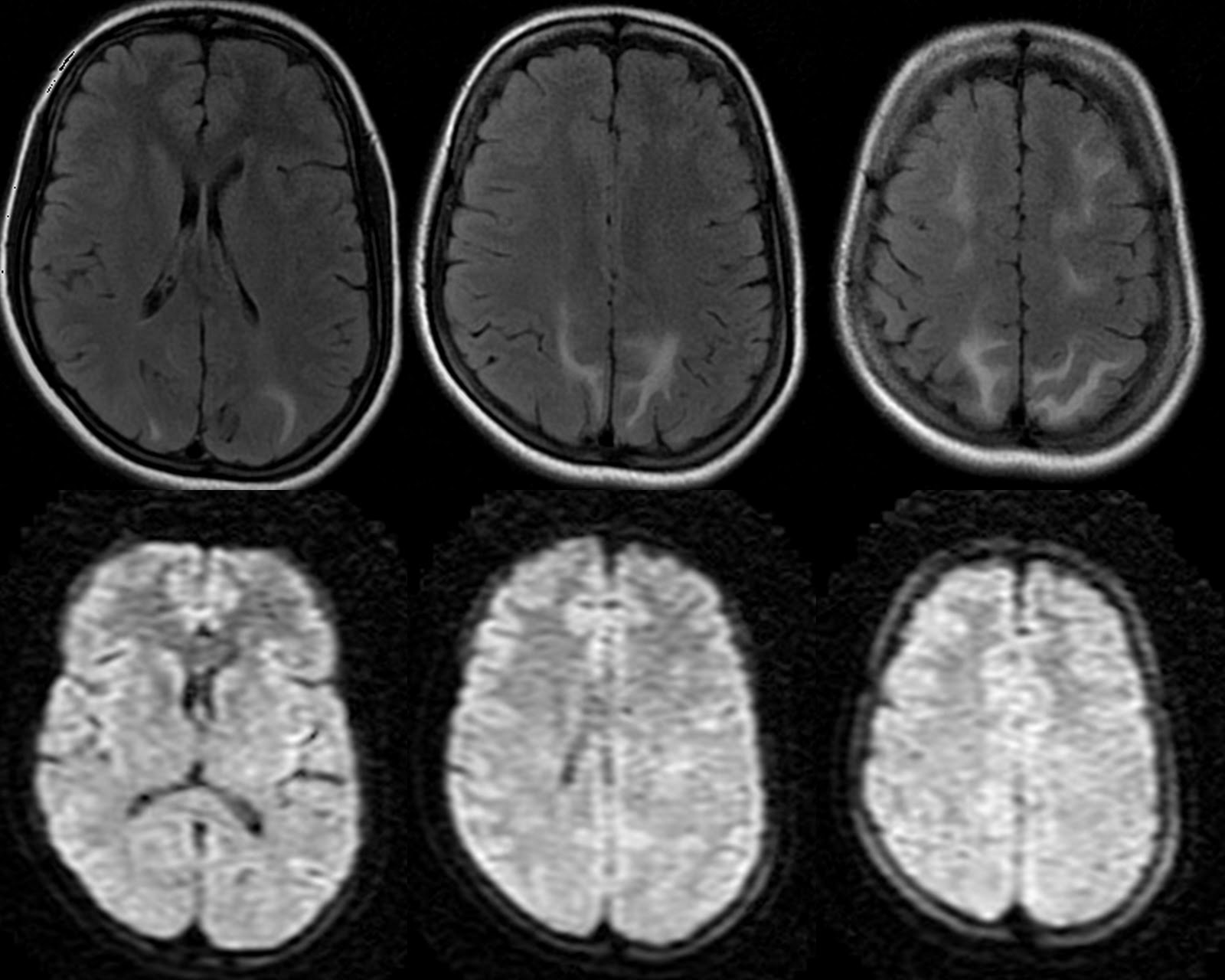 Dr Balaji Anvekar FRCR: Role of MRI Diffusion