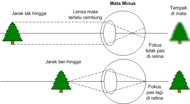 Mengenal Myopia / Mata Minus | jejaknoe.net
