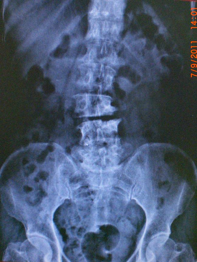 Phimaimedicine: 1,324. Vacuum disc sign