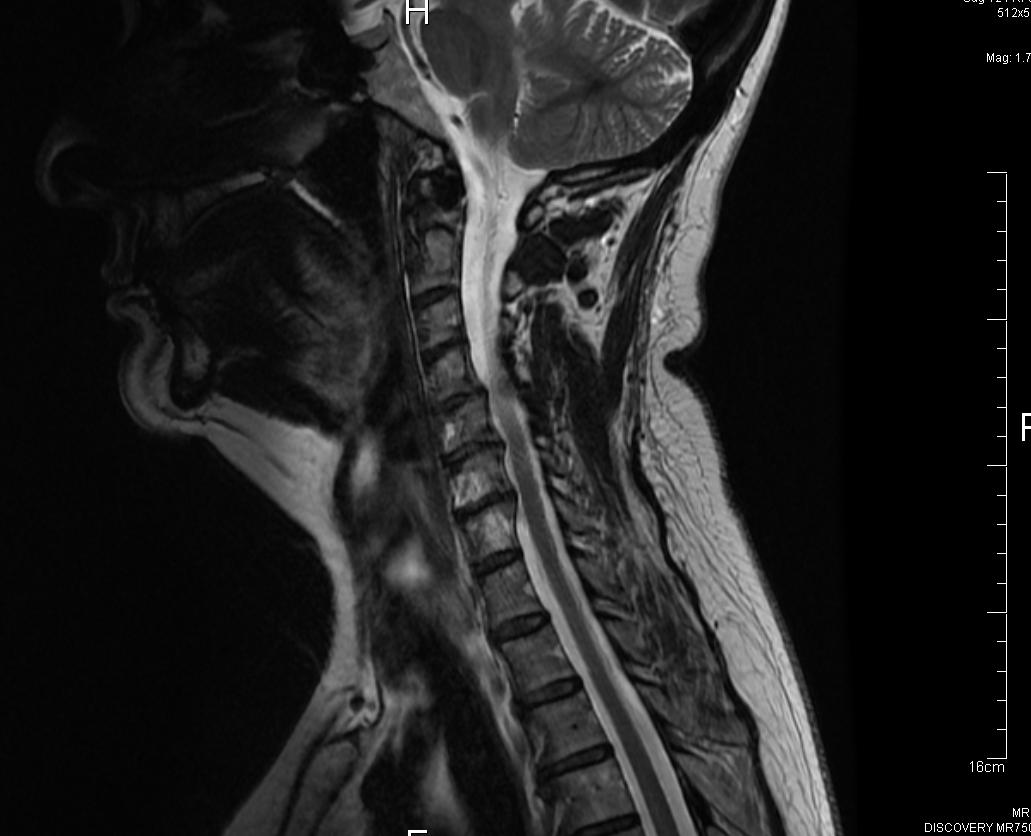 Reumails. Reumatología al día: Caso clínico: Hernias cervicales y ...