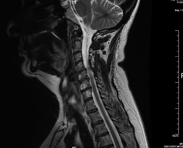 Reumails. Reumatología al día: Caso clínico: Hernias cervicales y ...