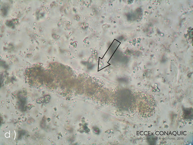 Caso UR-mayo-18 (Enfoque: cristaluria)