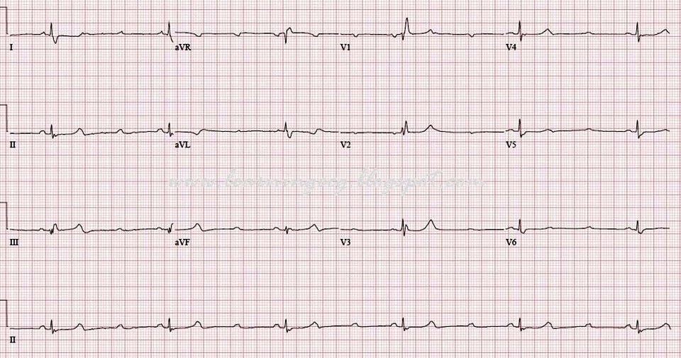 ECG Rhythms: Advanced AV block