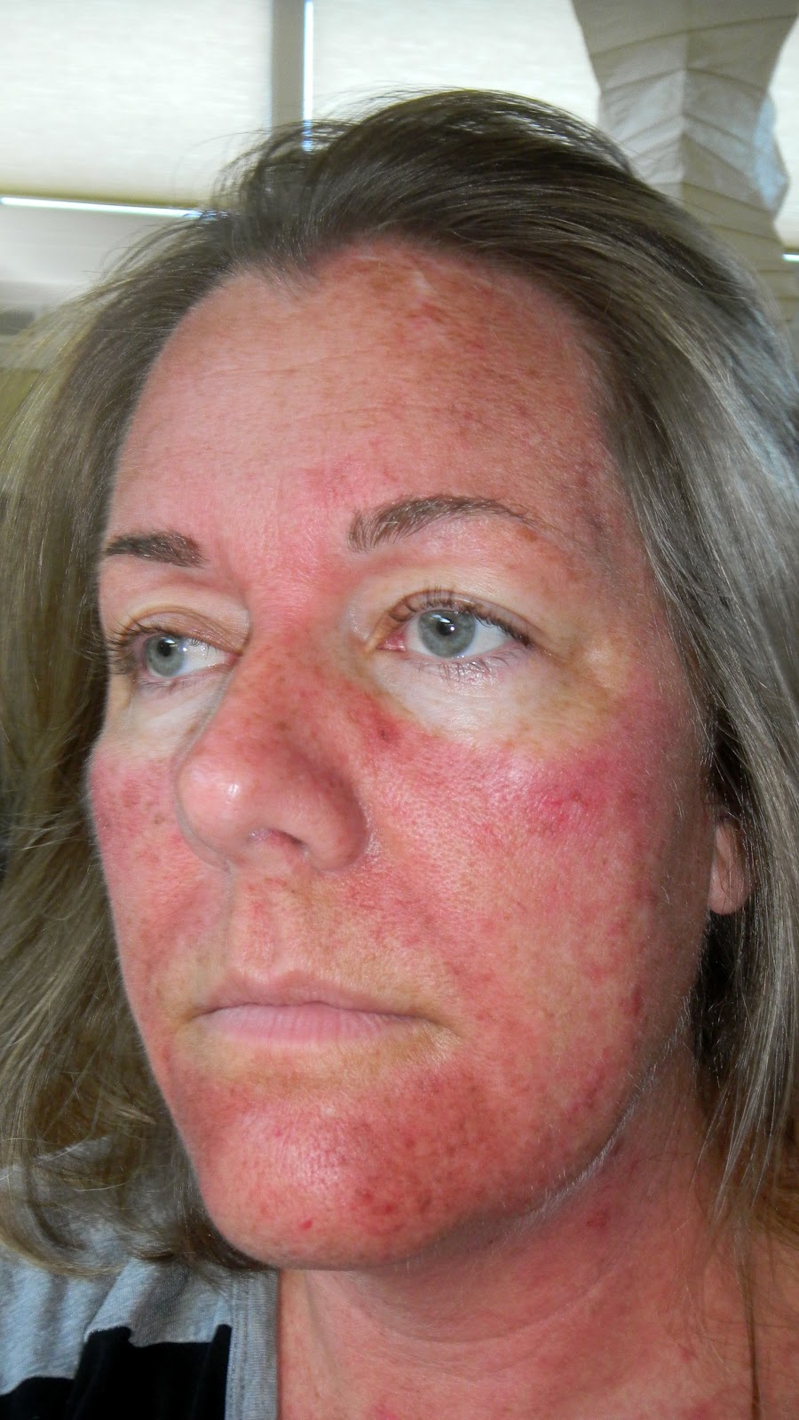 Efudex and Me 2013: Efudex Day Eleven