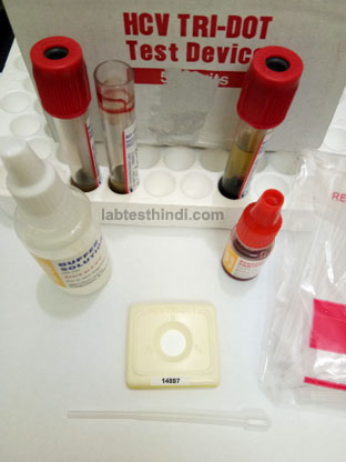 Hepatitis C ( HCV ) Test कैसे करते है ~ Lab Test Hindi