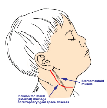 ENT for medical students: ENT PICTURES - PHARYNX