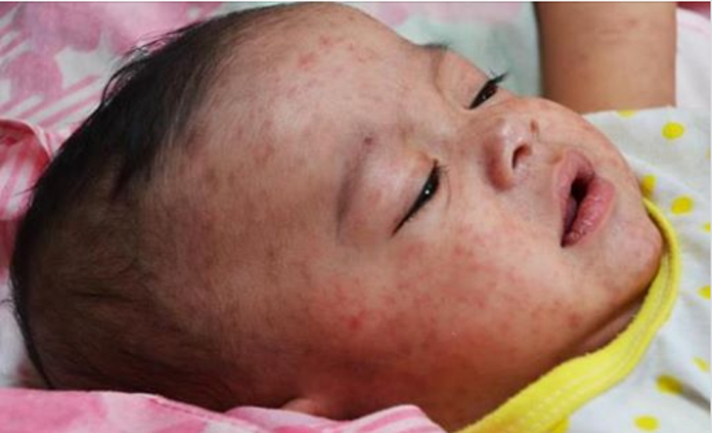 Informare Senza Censure: Malattia cutanea associata al vaccino che si ...