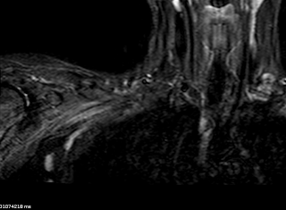 Brachial Plexitis -MRI - Sumer's Radiology Blog
