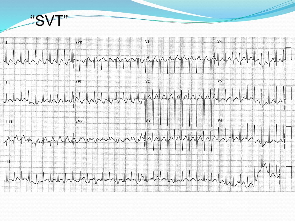 CVT Mohd Farid: Electrocardiogram ECG Part II Common Abnormalities Part I