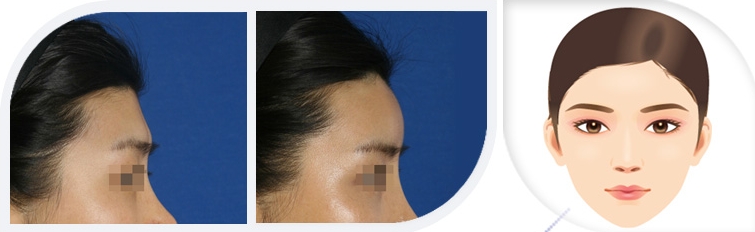 BK Plastic Surgery: [BK Plastic Surgery] Facial contouring: Forehead ...