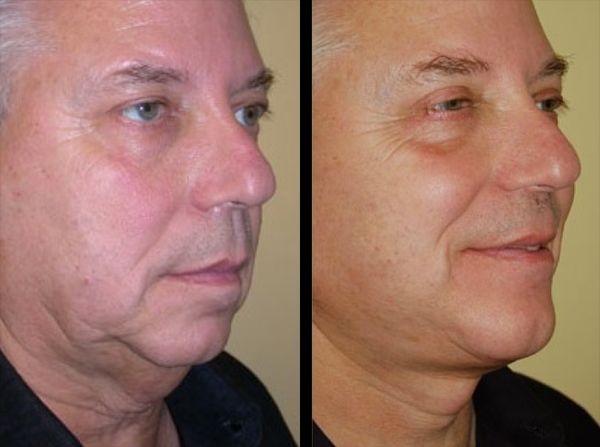 Facial Yoga Workouts For The Face And Neck Specifically For Men