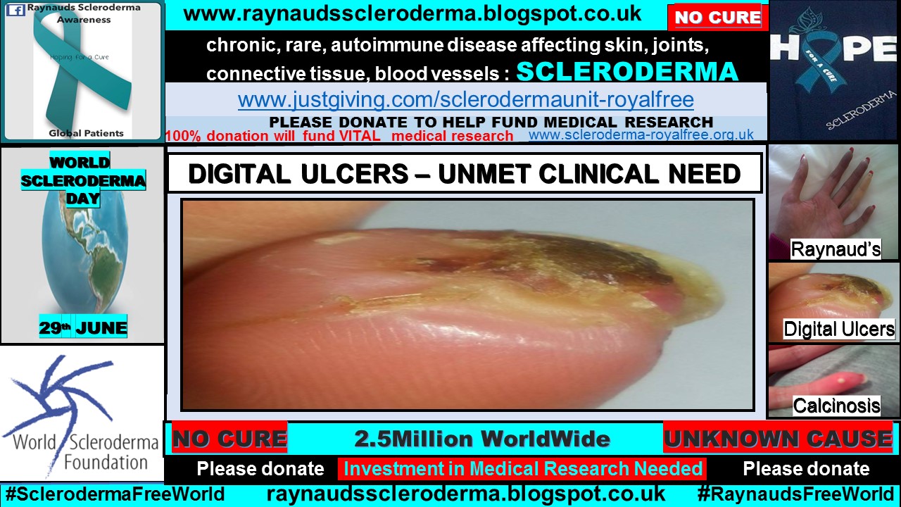 Raynauds Scleroderma Global Patients: DAY 24: Digital Ulcer Ischaemia ...