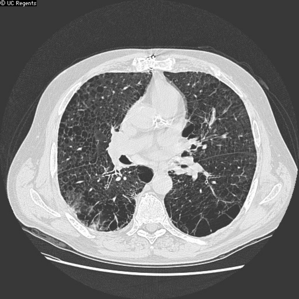 HEALTH FROM TRUSTED SOURCES: Lung transplantation