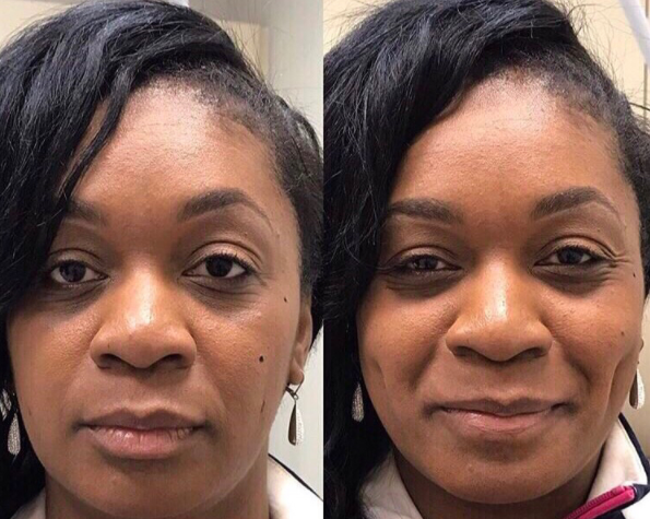 Latest Updates: The new craze ! Ladies are getting artificial dimples ...