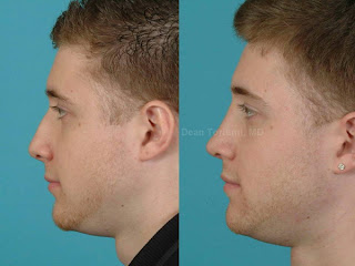 Dr. Dean Toriumi Reviews: Dr. Toriumi's operation to correct the ...