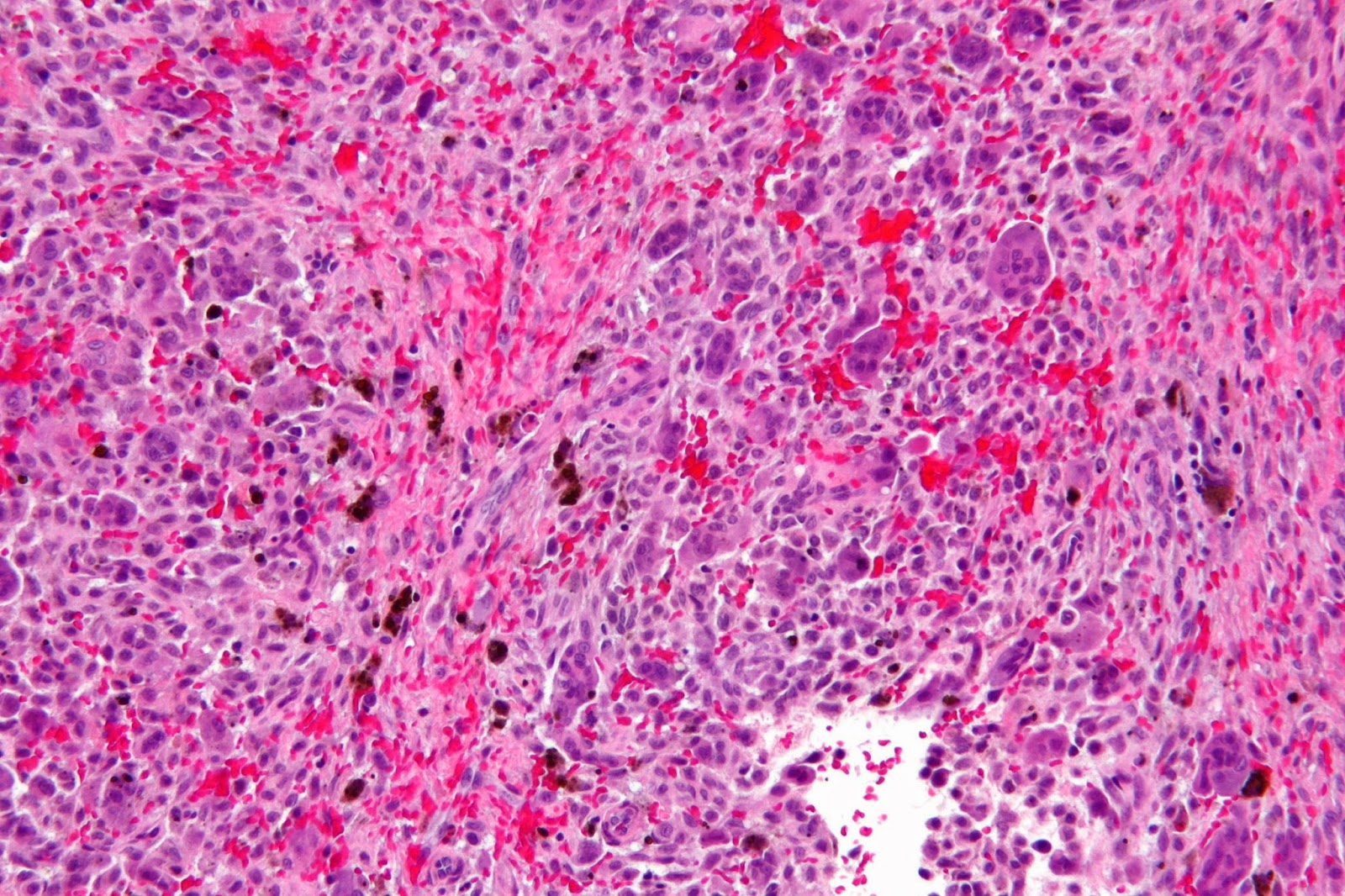 Fibroma De Células Gigantes - RETOEDU