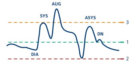 Critical Care Examination : IABP Graph Analysis