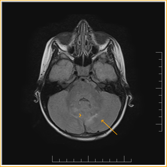 FASI-NF1 - Sumer's Radiology Blog