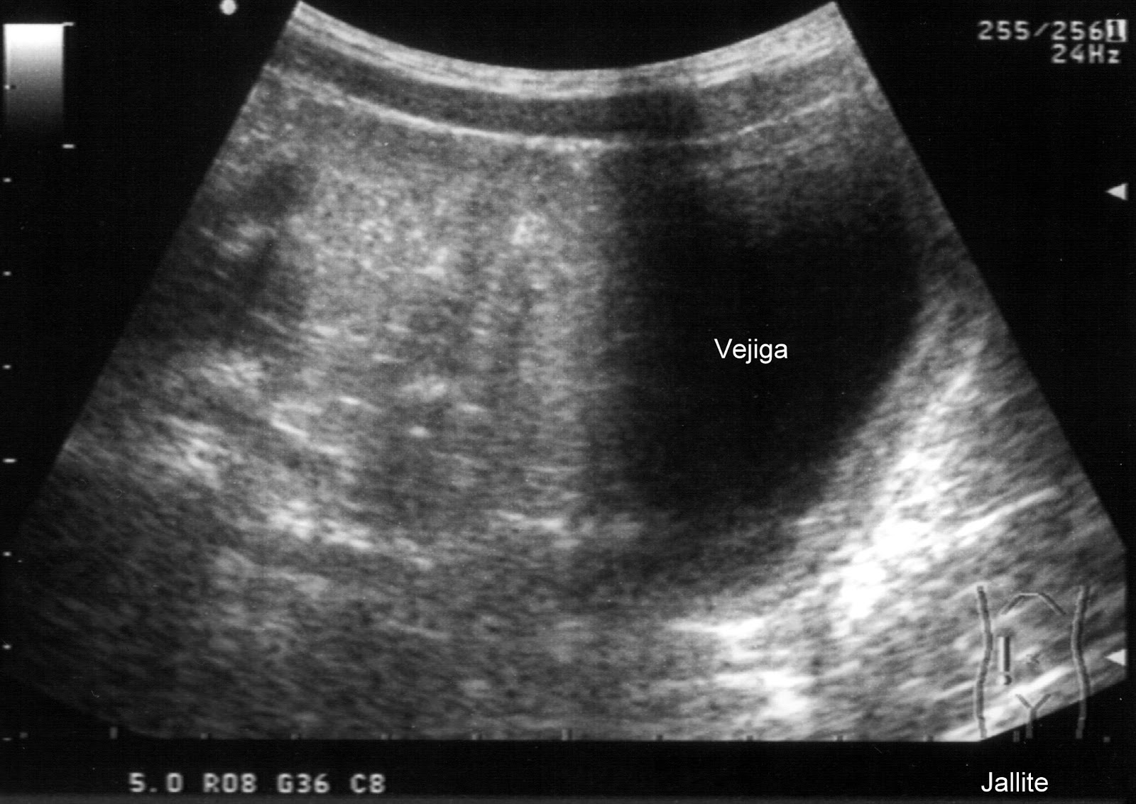 Cistitis Intersticial