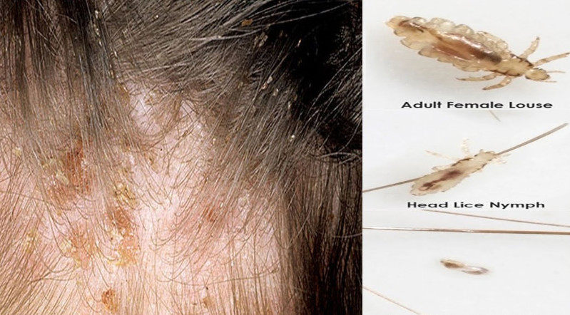 How To Get Rid Of Lice Fast - Caraway Seeds Health Benefits