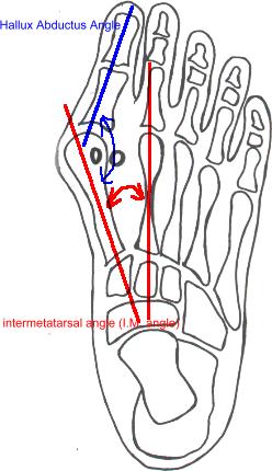 RHB and Physical Medicine: Halux Limitus / Rigidus The big Toe rules ...