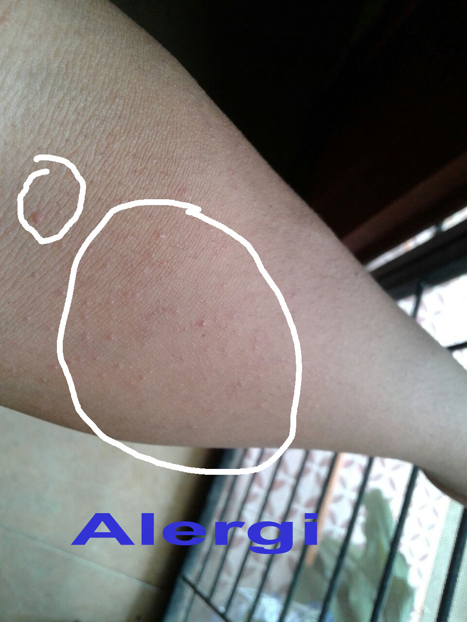 Alergi dan Penyebabnya (Allergen)