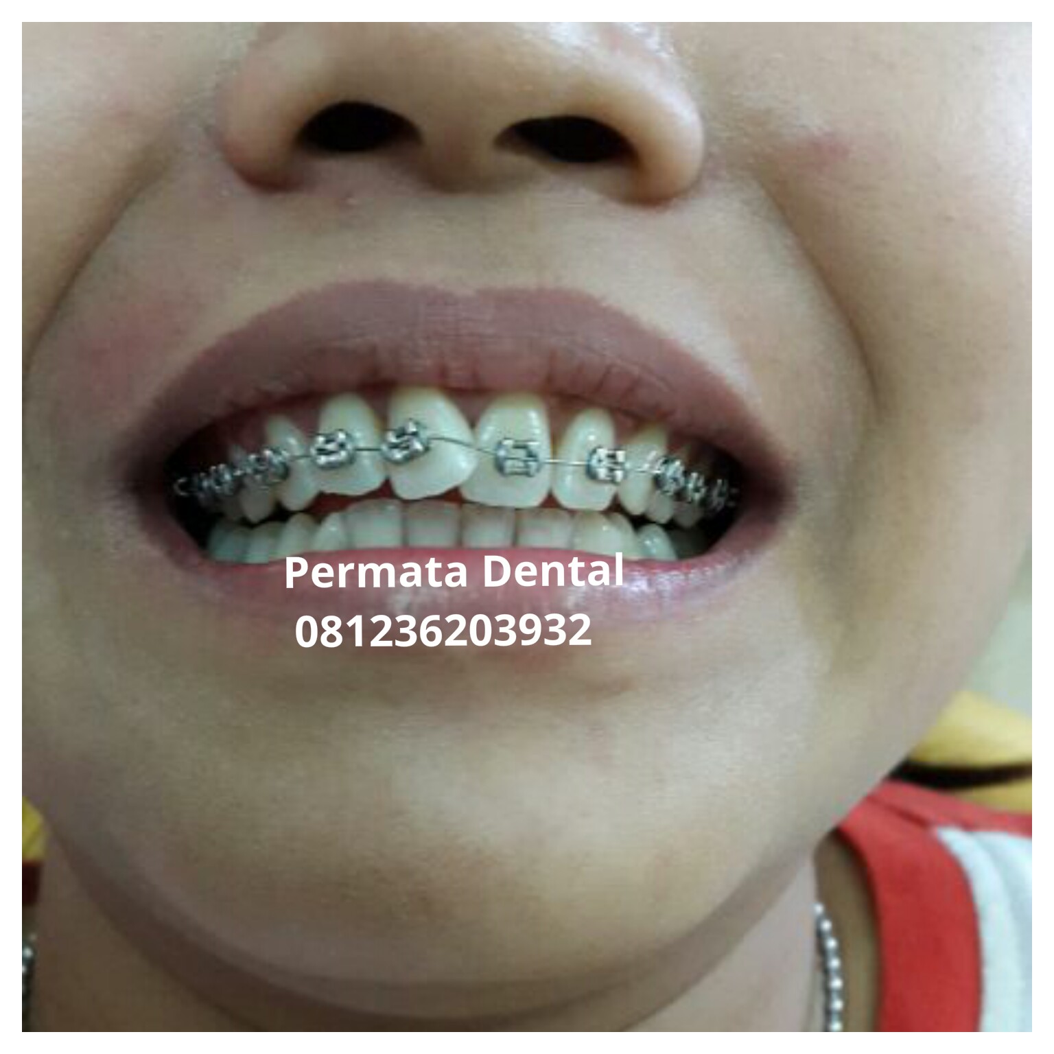 DOKTER GIGI BALI: Behel | Barcket | Kawat Gigi Perawatan