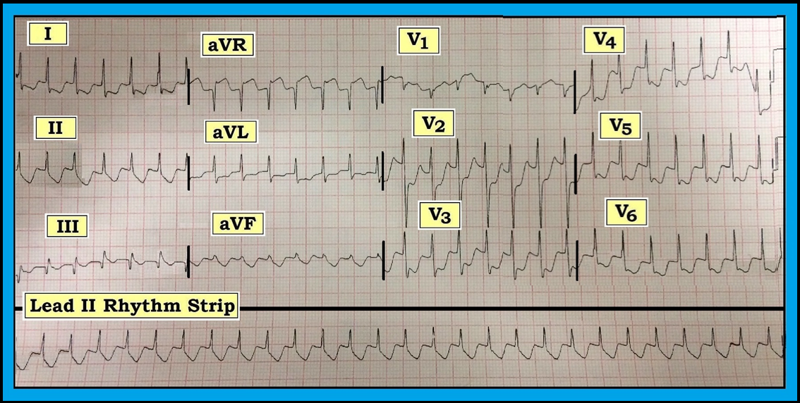 ECG Interpretation: ECG Blog #97 (ECG Video-Blog-3) - SVT with Marked ...