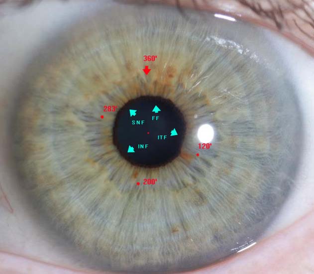 Modern & Multidimensional Iridology: Multiple Pupil Flattenings ...